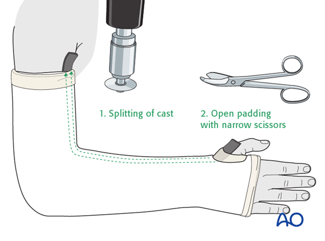 Immobilization with a cast