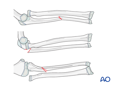 Closed reduction; cast immobilization for Monteggia lesion