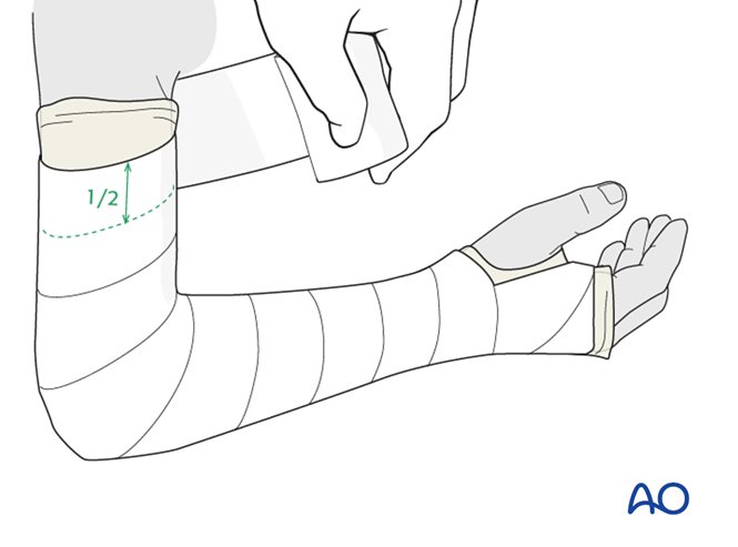 Closed reduction; cast immobilization for Monteggia lesion