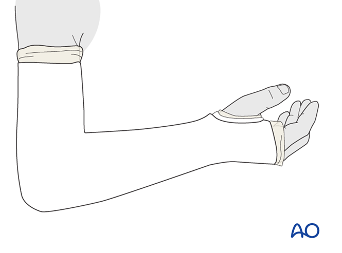 Closed reduction; cast immobilization for Monteggia lesion