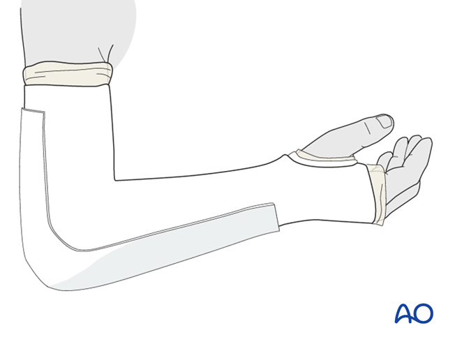 Closed reduction; cast immobilization for Monteggia lesion