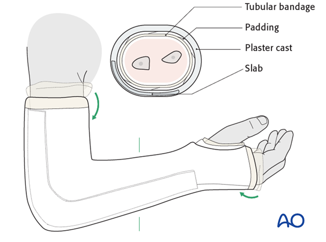 Closed reduction; cast immobilization for Monteggia lesion