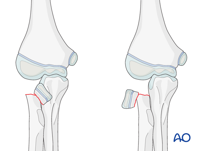 Open Reduction K Wire Fixation For Radius Metaphyseal Complete