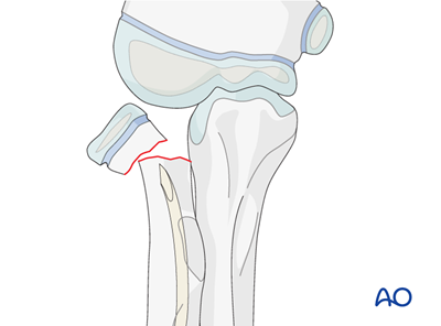 ESIN for Radius, metaphyseal, complete