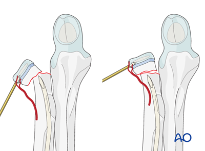 ESIN for Radius, metaphyseal, complete