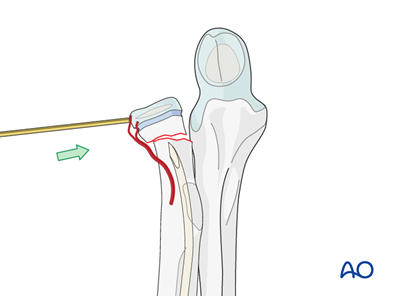 ESIN for Radius, metaphyseal, complete