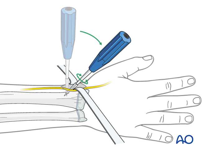 ESIN for Radius, epiphysiolysis, SH I