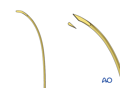 ESIN for Radius, epiphysiolysis with metaphyseal wedge, SH II