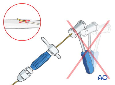 ESIN for Radius, epiphysiolysis, SH I