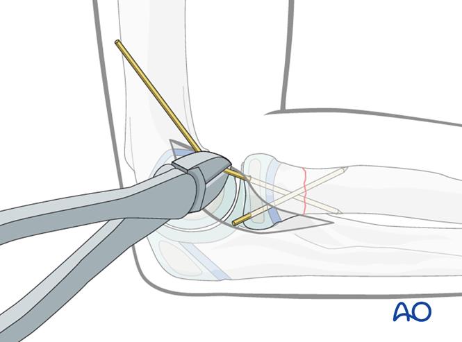 Open reduction; K-wire fixation for Radius, metaphyseal, complete