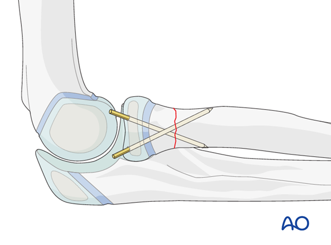 Open Reduction K Wire Fixation For Radius Metaphyseal Complete
