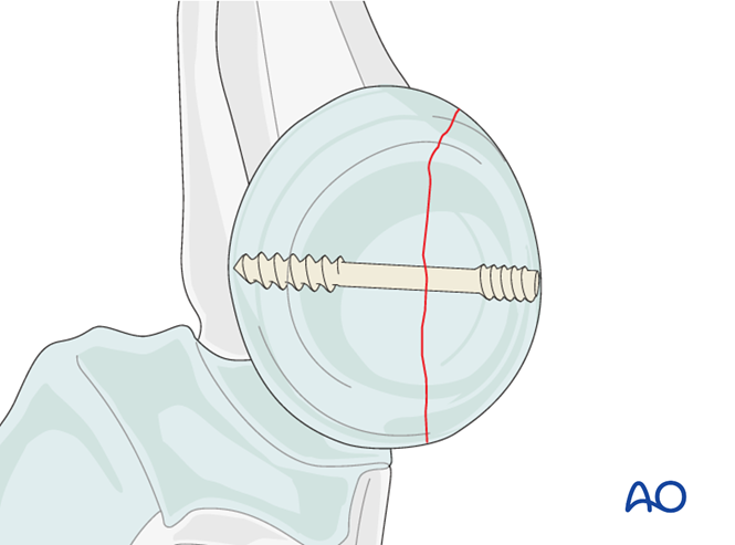 Open reduction; screw fixation for Radius, epi(meta)physeal, SH III + IV