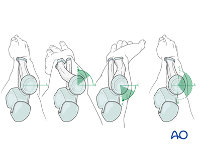 Open reduction; screw fixation for Radius, epi(meta)physeal, SH III + IV