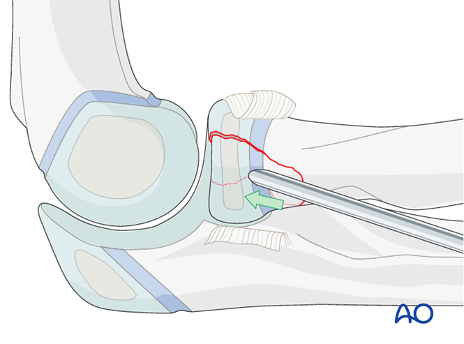 Open reduction; screw fixation for Radius, epi(meta)physeal, SH III + IV