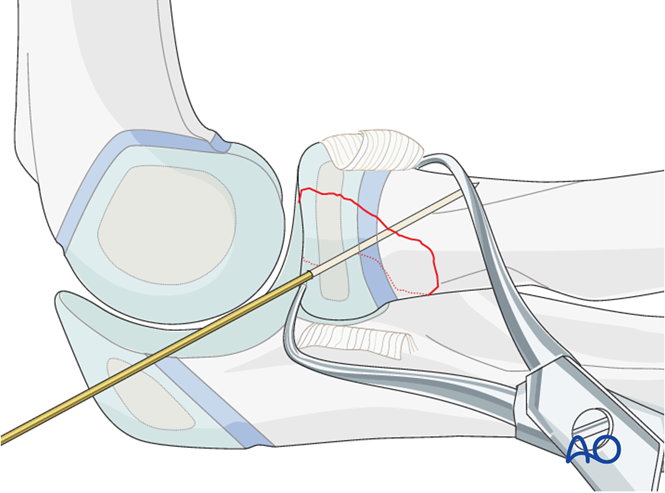 Open reduction; screw fixation for Radius, epi(meta)physeal, SH III + IV