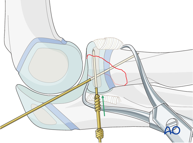 Open reduction; screw fixation for Radius, epi(meta)physeal, SH III + IV