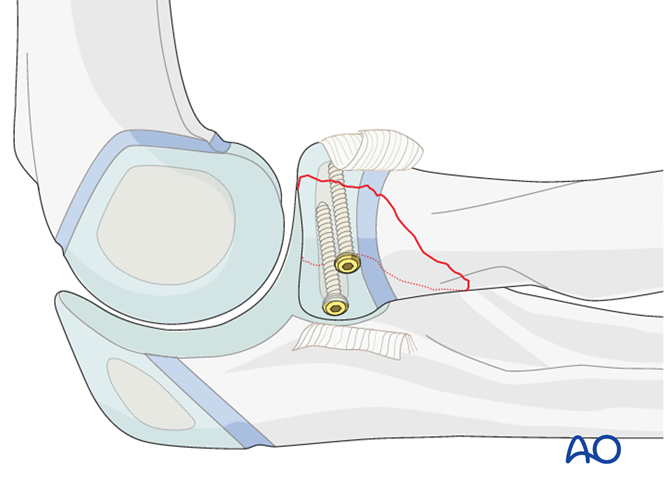 Open reduction; screw fixation for Radius, epi(meta)physeal, SH III + IV