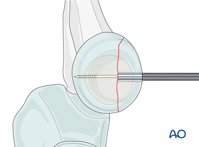 Open reduction; screw fixation for Radius, epi(meta)physeal, SH III + IV