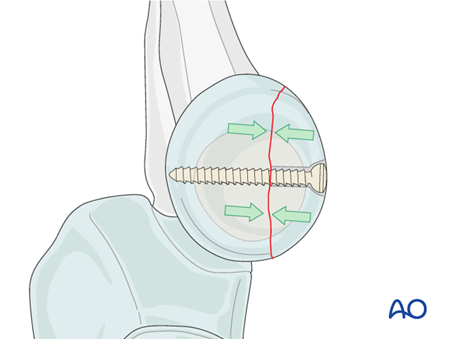 Open reduction; screw fixation for Radius, epi(meta)physeal, SH III + IV