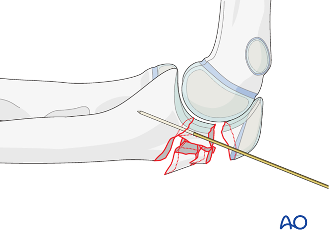 Plate fixation of multifragmentary olecranon fracture