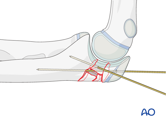 Plate fixation of multifragmentary olecranon fracture