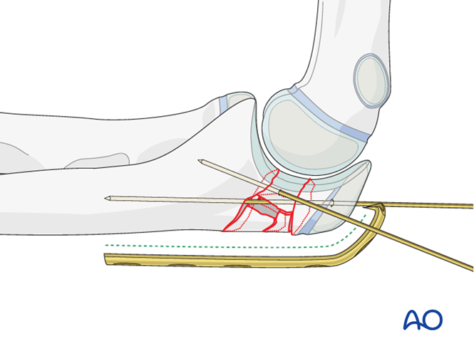 Plate fixation of multifragmentary olecranon fracture