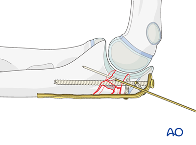 Plate fixation of multifragmentary olecranon fracture