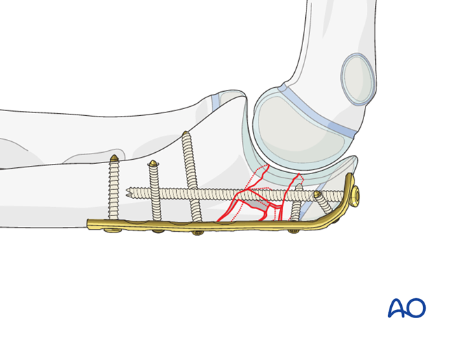 Plate fixation of multifragmentary olecranon fracture