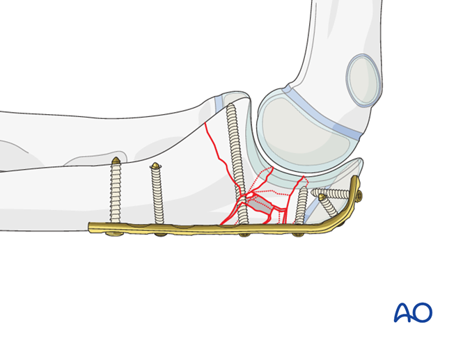 Plate fixation of multifragmentary olecranon fracture