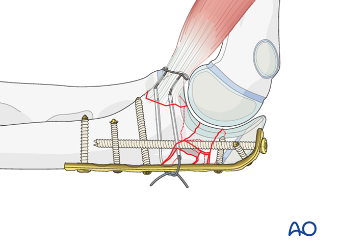 Plate fixation of multifragmentary olecranon fracture
