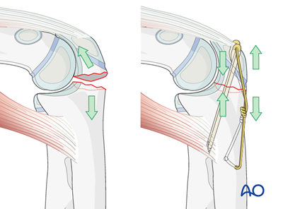 Tension band fixation of olecranon fracture