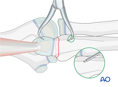 Tension band fixation of olecranon fracture