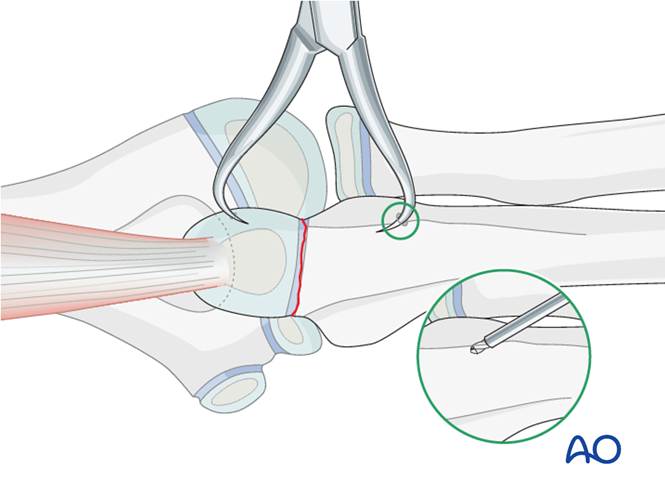 Open reduction; tension band fixation for Ulna, avulsion of apophysis