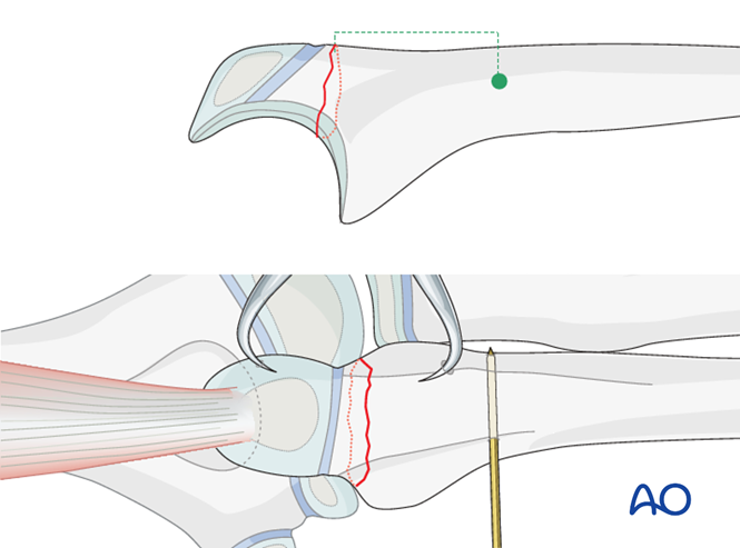 Tension band fixation of olecranon fracture
