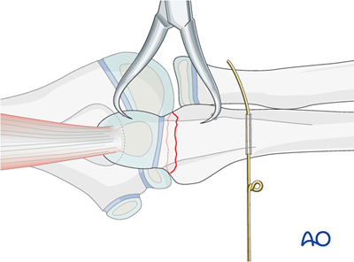 Tension band fixation of olecranon fracture