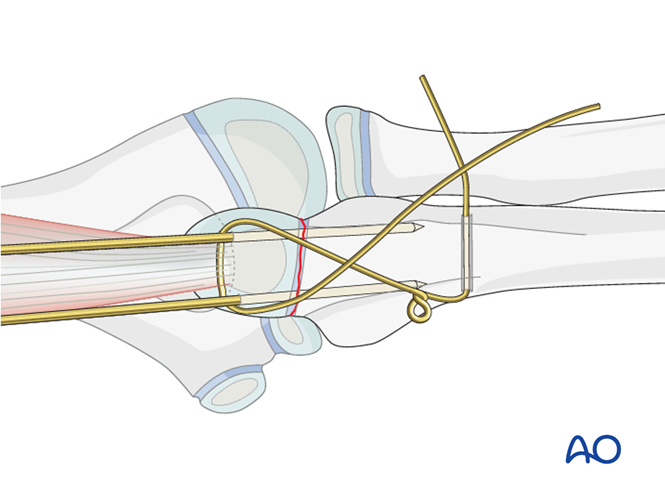 Open reduction; tension band fixation for Ulna, avulsion of apophysis