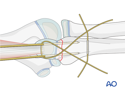 Tension band fixation of olecranon fracture