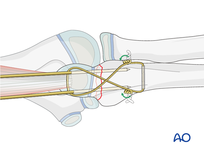 Tension band fixation of olecranon fracture