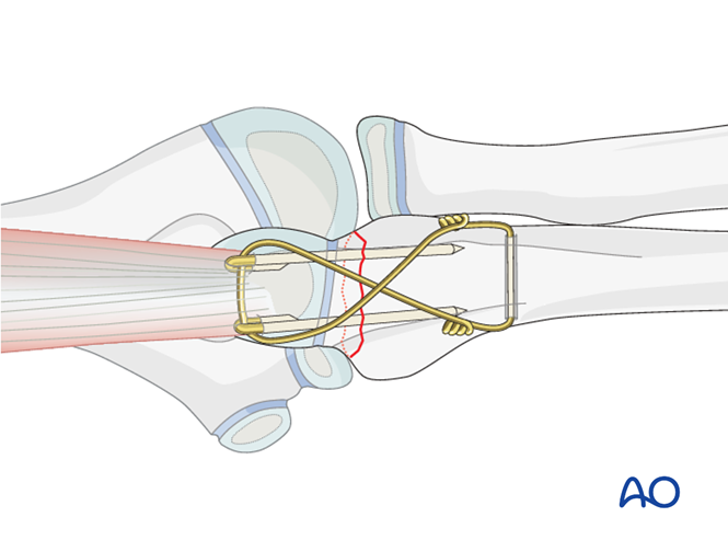 Tension band fixation of olecranon fracture