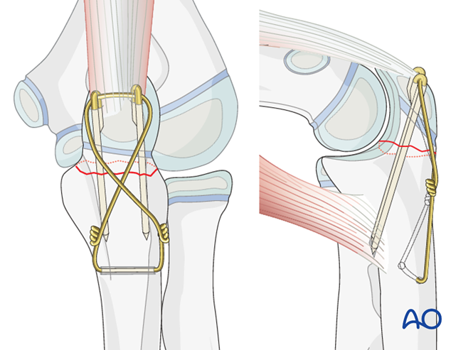 Tension band fixation of olecranon fracture