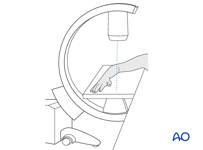 ESIN for Monteggia equivalent