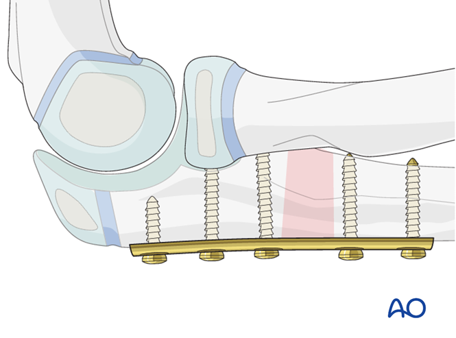 Open reduction; plate fixation for Monteggia lesion