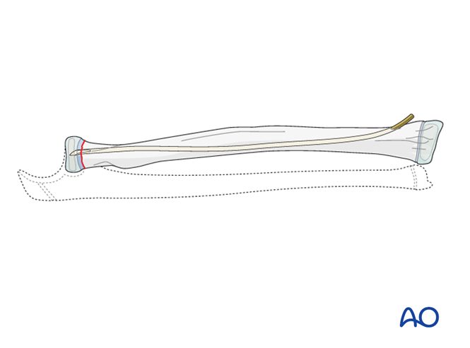 ESIN for Monteggia equivalent