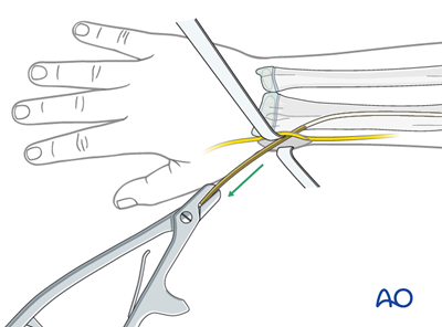 Open reduction; internal fixation for Radial head/neck + olecranon fracture