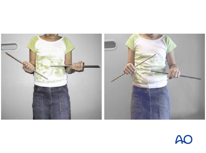 Concept of fracture treatment and long-term restoration of arm function