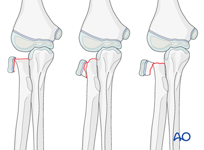 Concept of fracture treatment and long-term restoration of arm function