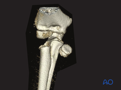 Complications of radial head and neck fractures