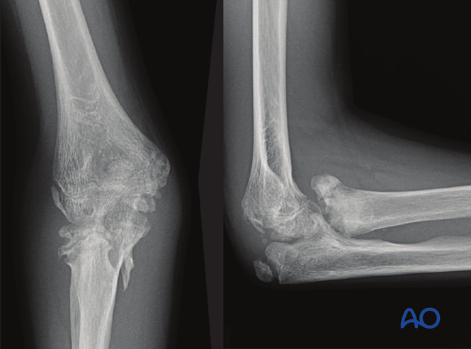Complications of radial head and neck fractures