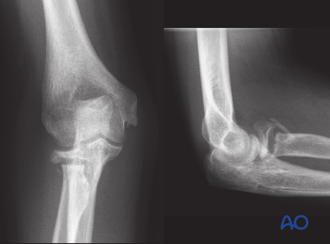 Complications of radial head and neck fractures