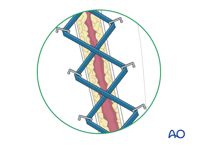 Compartment syndrome